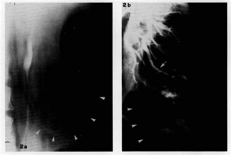 Figure 2 From Angiographic Manifestations Of Renal Hamartoma Semantic