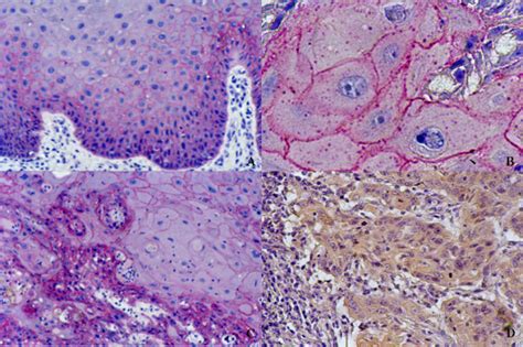 Strong Basal Parabasal Membranous Expression Of P Cadherin In Oral Download Scientific Diagram