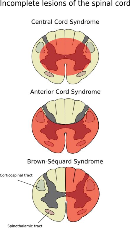 Central Cord Syndrome Wikipedia