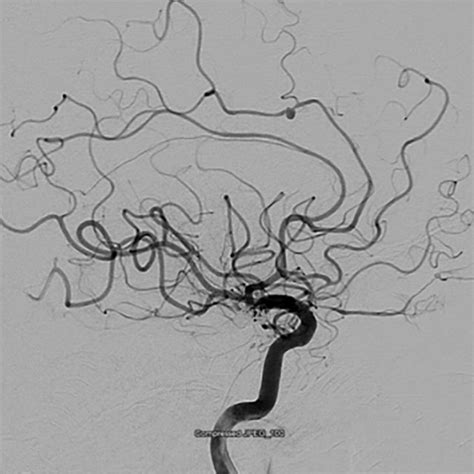 Repeat Angiogram On Post Bleed Day 9 Reveals A Pseudoaneurysm Of The