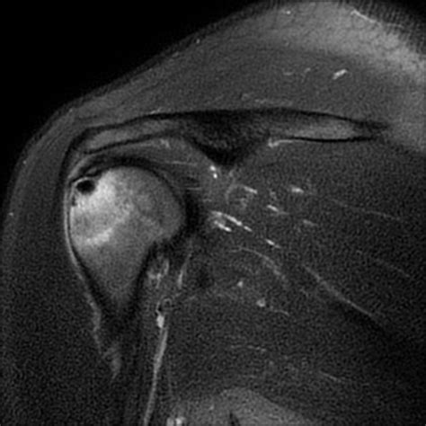 Calcific Tendinitis Pacs