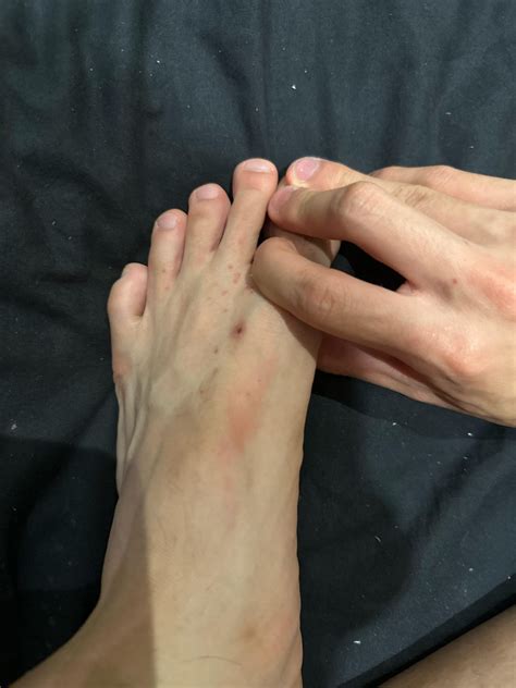 Getting Spots All Over My Body Rdermatology