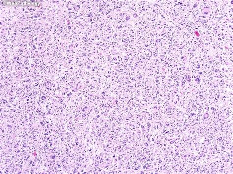 Stromal Sarcoma Of Prostate