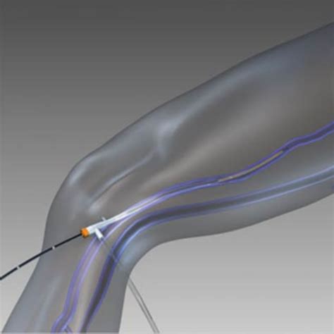 Vein And Vascular Treatment Closurefast