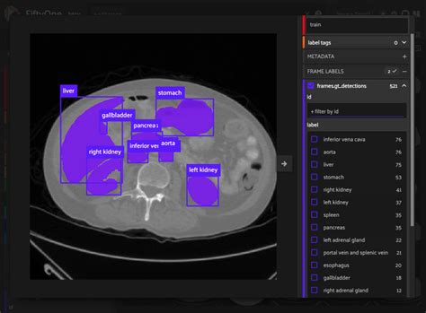 voxel51 btcv ct as video medsam2 dataset · datasets at hugging face