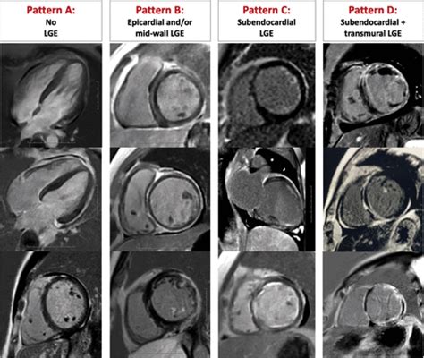 Subendocardial Involvement As An Underrecognized Cardiac Mri Phenotype