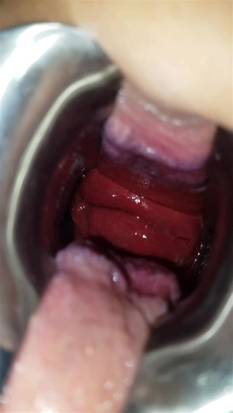 Juicy Speculum Thisvid Com