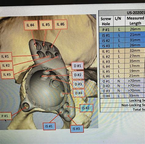 Custom Triflange Acetabular Component Ryan Robertson Md