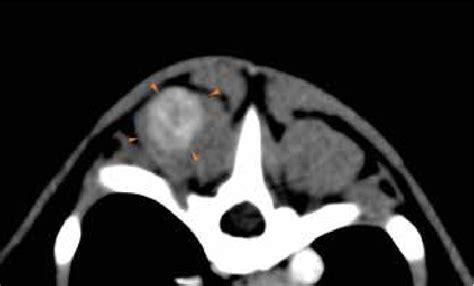 Rounded And Heterogeneous Nodular Contrastenhancing Muscular Lesion In Download Scientific