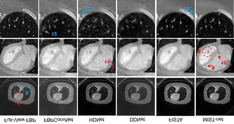 Clinical Cardiac Ct Reconstructions From Sparse View Data By Using