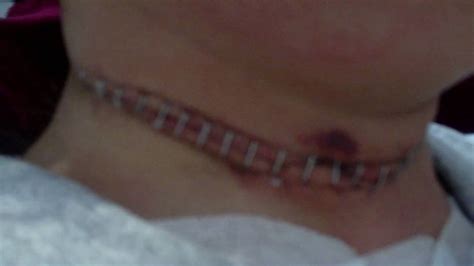 Removing Thyroid Cyst Surgery At Lisa Rubino Blog