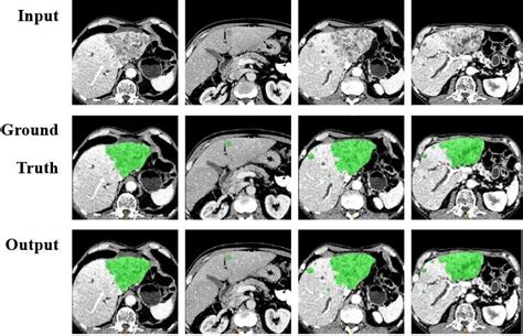 Examples Of Automatic Liver Tumor Segmentation Results From The Download Scientific Diagram