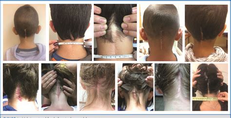 Figure 3 From The “three On A Stick” Incision—a Curvilinear Solution For The Occipital And