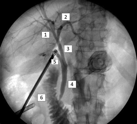 Should We Utilize Routine Cholangiography Advances In Surgery Should We Utilize Routine Cholangiography Advances In Surgery