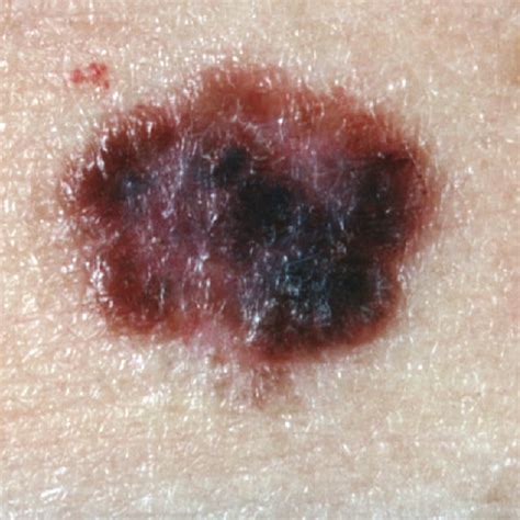 What Is Melanoma Leeds Teaching Hospitals Nhs Trust