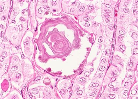 Pathology Outlines Calcification