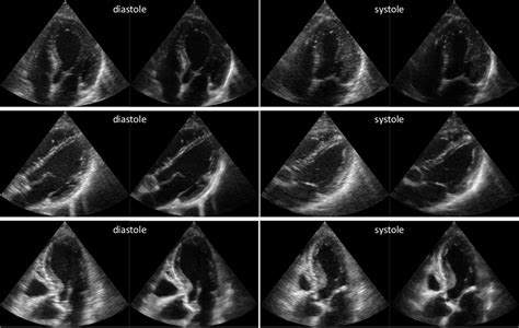 Figure 1 From Adaptive Contrast Enhancement Of Cardiac Ultrasound