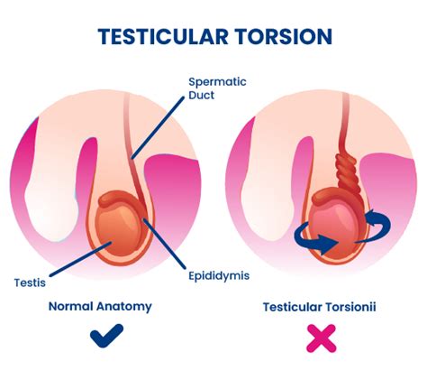 Testicular Torsion Anupama Hospitals
