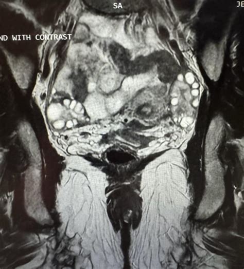 Mri Findings Suggestive Of Mild Adenomyosis Radenomyosis