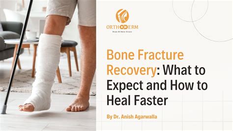 Fracture Recovery What To Expect And How To Heal Faster