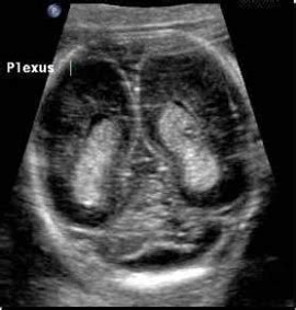 Choroid Plexus Ultrasound