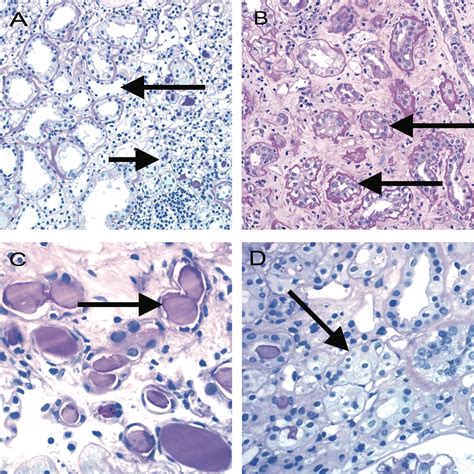 Reference Guide To The Banff Classification Banff
