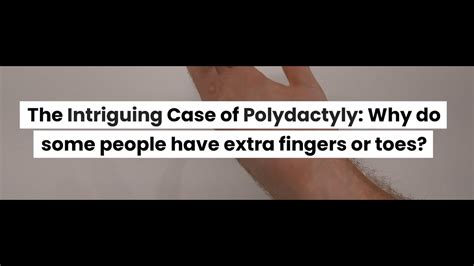 The Intriguing Case Of Polydactyly Why Do Some People Have Extra Fingers Or Toes Youtube