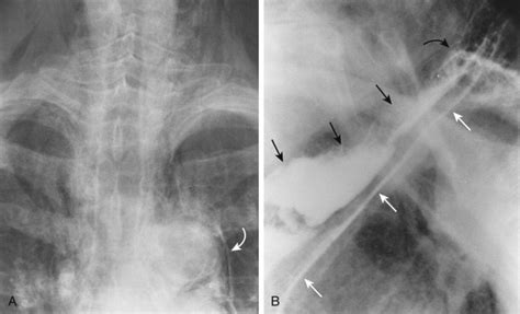 Miscellaneous Abnormalities Of The Esophagus Radiology Key