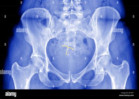 Gynecology Iud Hi Res Stock Photography And Images Alamy