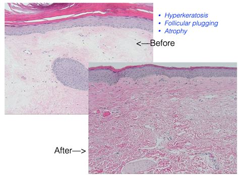 Lichen Sclerosus Toronto Vitalitymd Toronto