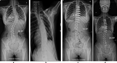 This 14 Year Old Female Patient Was In The Group Risser Grade 3 To 5 Download Scientific