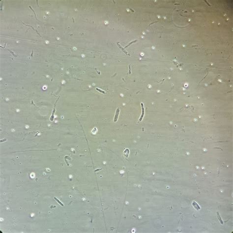 Hyaline Casts Identification And Clinical Significance Medlabbuddy