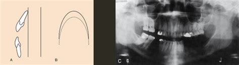 Panoramic X Ray Errors Flashcards Quizlet