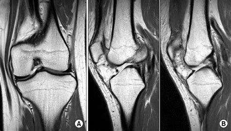 A Hypoplasia Of The Medial Femoral Condyle And Narrow Intercondylar Download Scientific