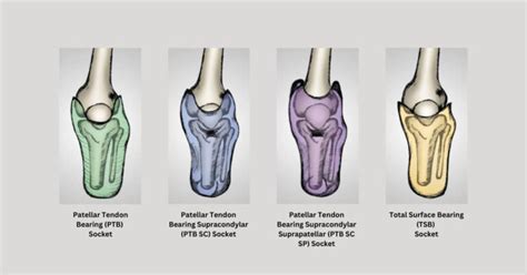 Prosthetic Socket Explained Types Process Solutions And More Prosthetic Socket Explained Types Process Solutions And More