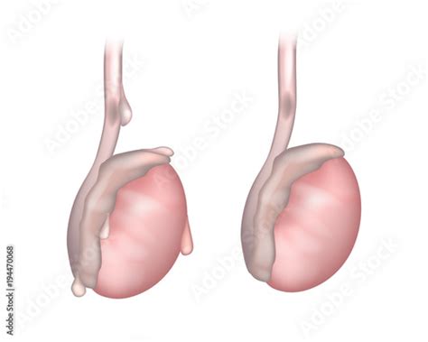Side View Of Testicle Showing Twisted Testicular Appendage An Appendix Testes Hydatid Of
