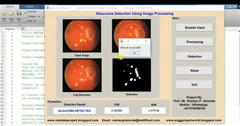 Glaucoma Detection Using Image Processing Glaucoma Detection Using Matlab Project With Source