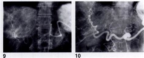 62 Year Old Woman With Peripheral Cholangiocarcinoma Celiac Angiogram Download Scientific