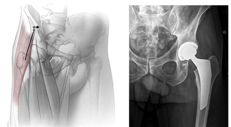 Anterior Hip Replacement