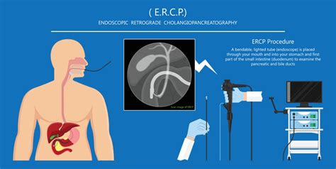 Endoscopic Retrograde Cholangiopancreatography Ercp Bangkok