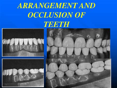 What Is Occlusion Part 1 Dental Occlusion Definition Wtqm