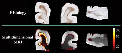 Science Update Nih Developed Multidimensional Mri Can Detect Invisible” Brain Injuries