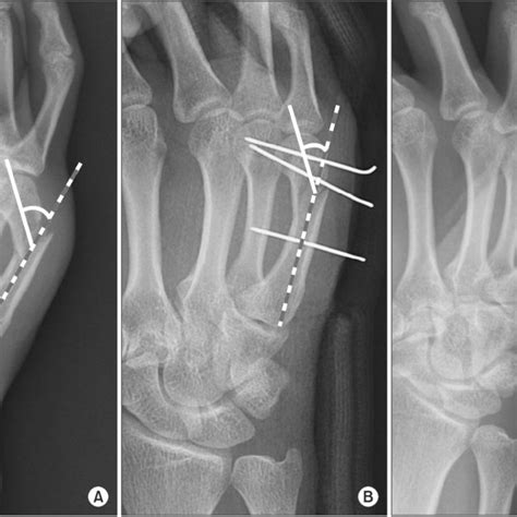Fracture Angles Were Analysed Based On The Difference Between Download Scientific Diagram
