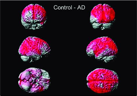 Intergroup Comparison Of Cerebral Vasoreactivity Shows Significant