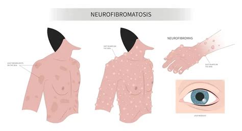 Neurofibromatosis Overview And Treatment Options
