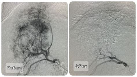 Ahmed Bessar On Linkedin In Hepatic Chemoembolization Dont Neglect