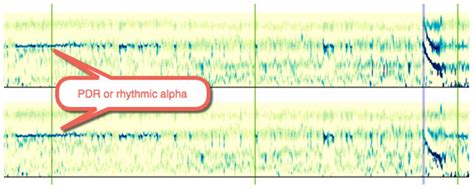 Persyst Video Library Persyst