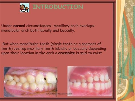 Posterior Crossbite In Primary And Mixed Dentition Etiology And Manag