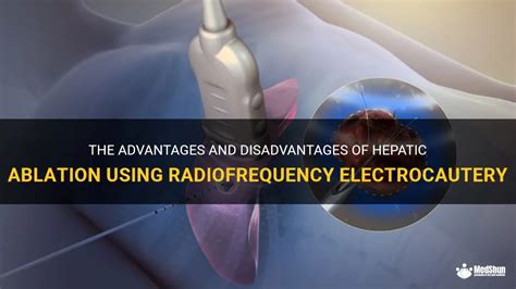 The Advantages And Disadvantages Of Hepatic Ablation Using Radiofrequency Electrocautery Medshun