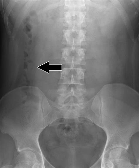 Ascites Is An Abnormal Accumulation Fluid In Abdomen
